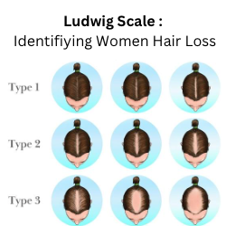 Ludwig Scale: identifying Women Pattern Hair Loss – Deresina Headwear